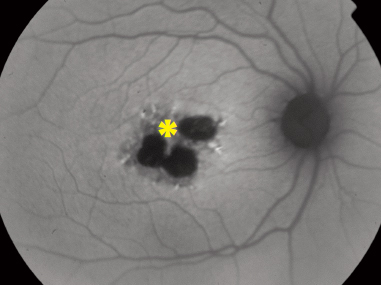 Retinal Physician | PentaVision