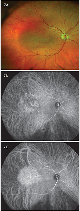 Retinal Physician | PentaVision