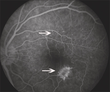 Retinal Physician | PentaVision
