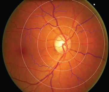 Retinal Physician | PentaVision