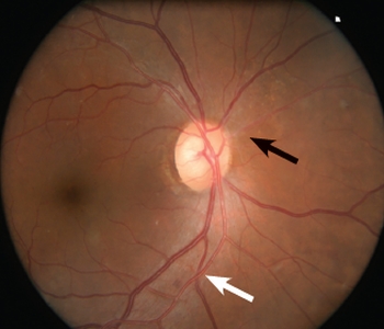 Retinal Physician | PentaVision