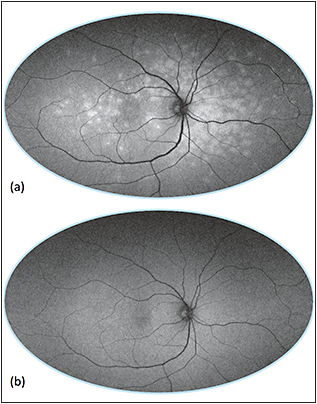 Retinal Physician | PentaVision