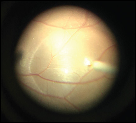 Retinal Physician | PentaVision