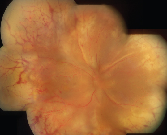 Retinal Physician | PentaVision