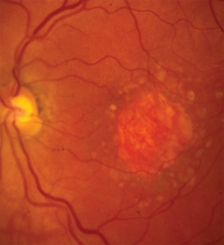 Retinal Physician | PentaVision