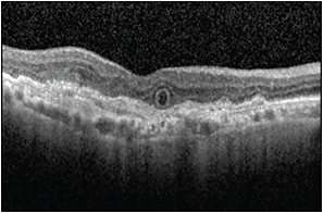 Retinal Physician | PentaVision