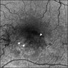 Retinal Physician | PentaVision