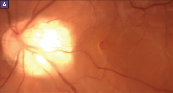 Retinal Physician | PentaVision