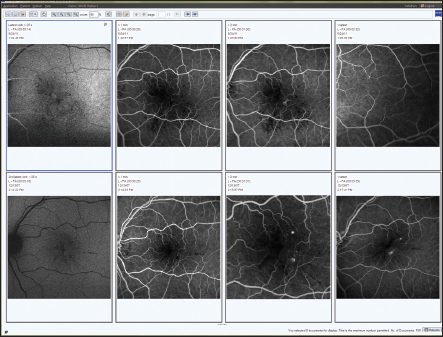 Retinal Physician | PentaVision