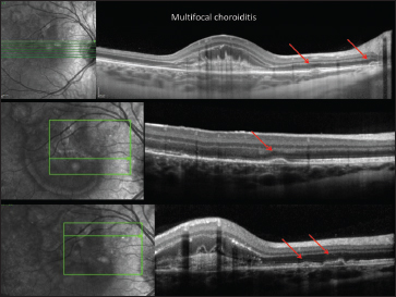 Retinal Physician | PentaVision