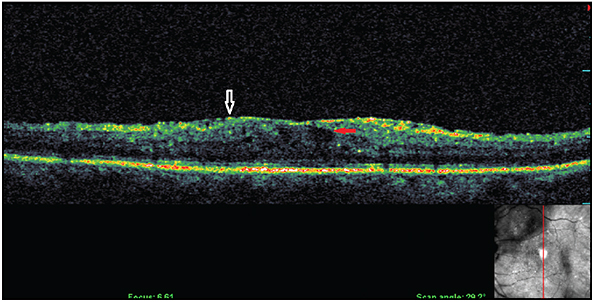 Retinal Physician | PentaVision