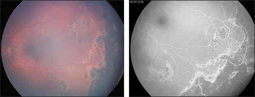 Retinal Physician | PentaVision
