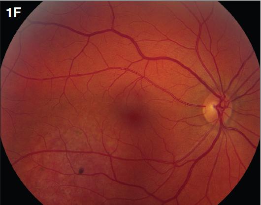 Retinal Physician | PentaVision