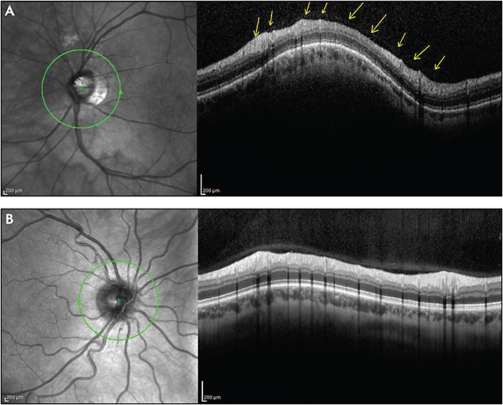 Retinal Physician | PentaVision