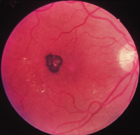 Retinal Physician | PentaVision