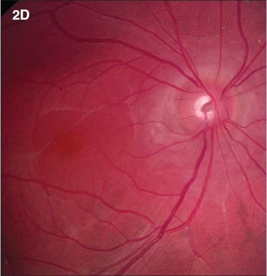 Retinal Physician | PentaVision