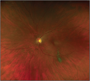 Retinal Physician | PentaVision