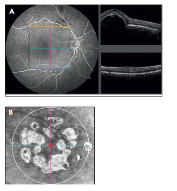 Retinal Physician | PentaVision
