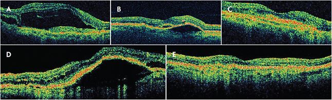 Retinal Physician | PentaVision