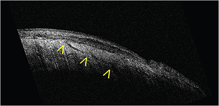Retinal Physician | PentaVision