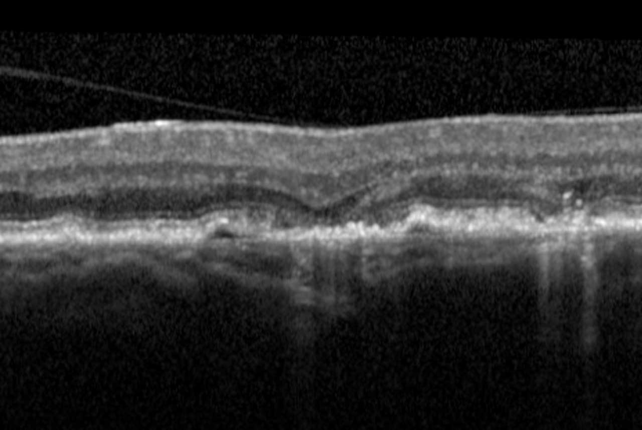 Imaging Features That Portend Development of Geographic Atrophy ...
