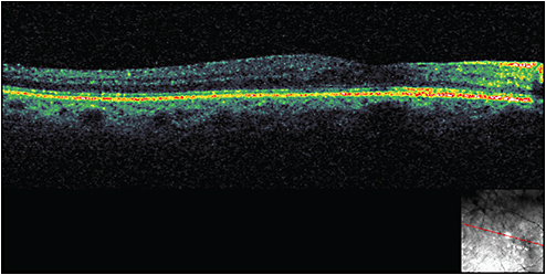 Retinal Physician | PentaVision