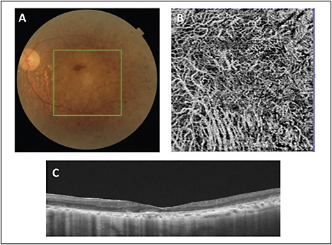 Retinal Physician | PentaVision