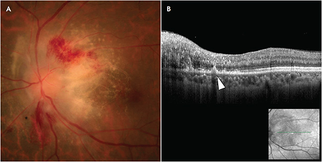 Retinal Physician | PentaVision