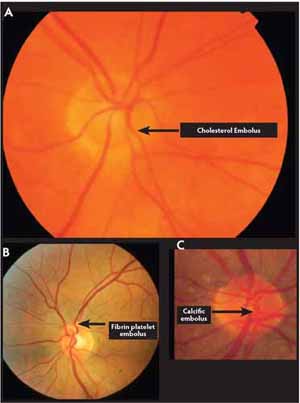 Retinal Physician | PentaVision