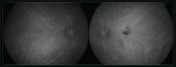 Retinal Physician | PentaVision