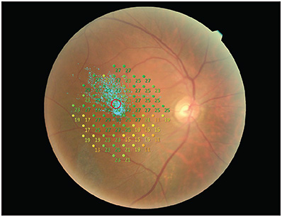 Retinal Physician | PentaVision