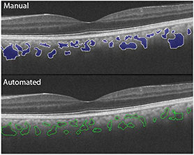 Retinal Physician | PentaVision