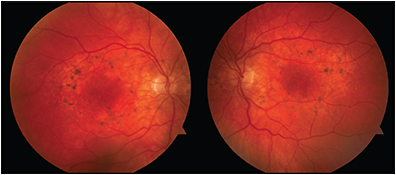 Retinal Physician | PentaVision