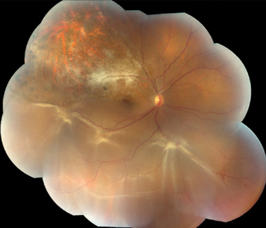 Retinal Physician | PentaVision