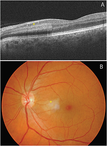 Retinal Physician | PentaVision