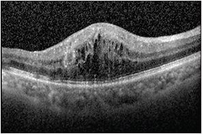 Retinal Physician | PentaVision