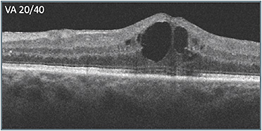 Retinal Physician | PentaVision