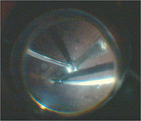 Retinal Physician | PentaVision