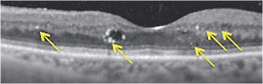 Retinal Physician Pentavision