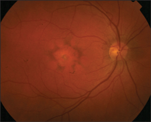 Retinal Physician | PentaVision