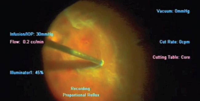 Retinal Physician | PentaVision