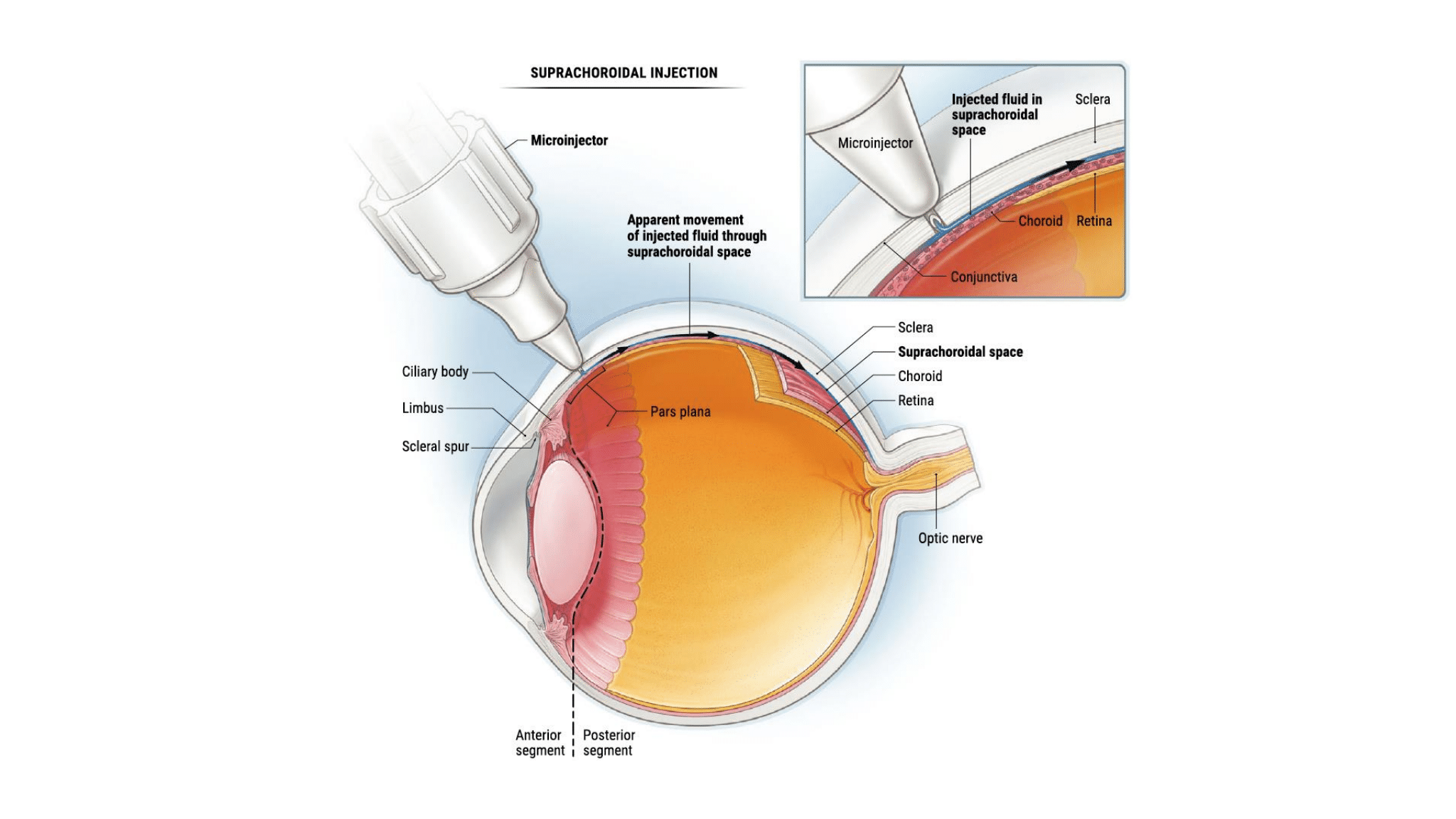 Retinal Physician Pentavision