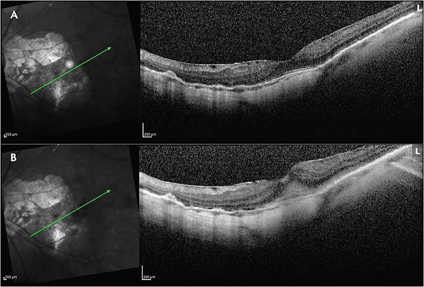 Retinal Physician | PentaVision