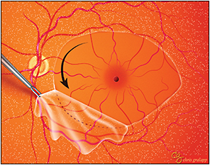 Retinal Physician | PentaVision