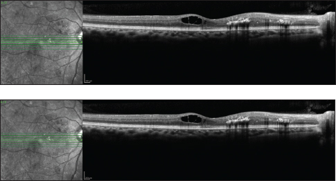Retinal Physician | PentaVision