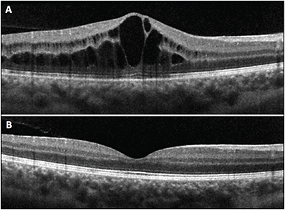 A Summary of the MERIT Trial: Intravitreal Therapy for Uveitic Macular ...