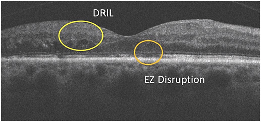 Retinal Physician Pentavision