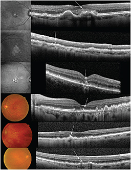 Retinal Physician | PentaVision