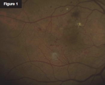 Retinal Physician | PentaVision