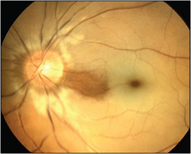 Retinal Physician | PentaVision